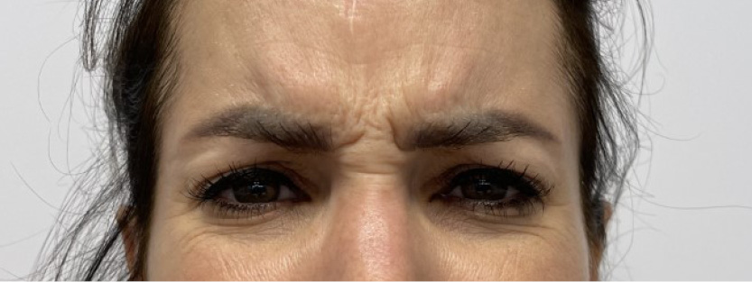 Botox behandeling voor fronsrimpel | Cosmetique Totale