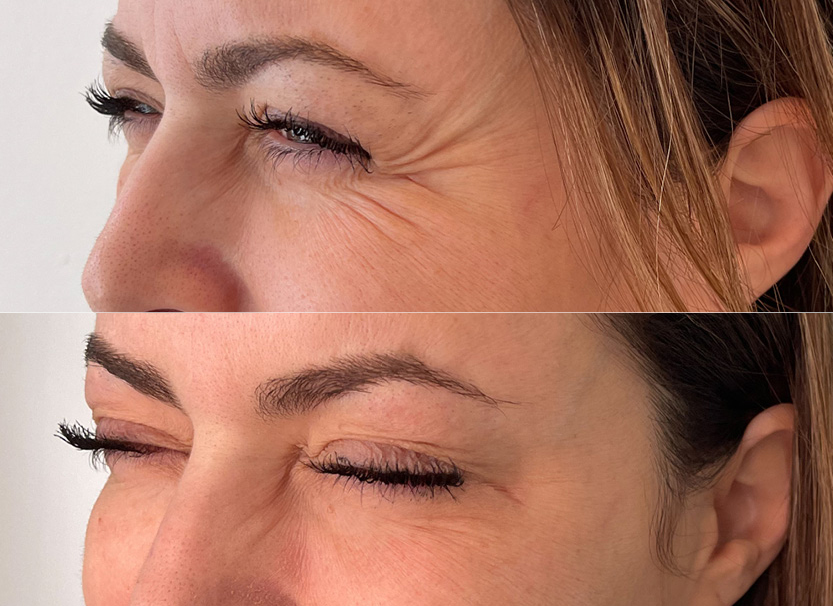 Botox behandelingen | Cosmetique Totale