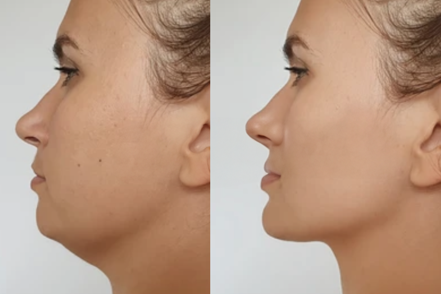 Acide hyaluronique menton | Comblement naturel du profil