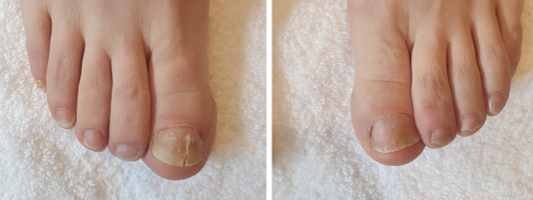 Ongles fongiques | Tout savoir sur l'onychomycose.