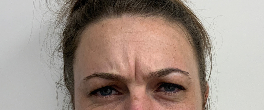 Botox behandeling voor fronsrimpel | Cosmetique Totale