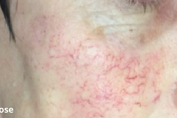 Rougeurs sur votre visage | Rosacée & couperose