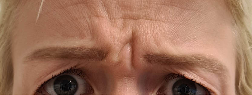 Botox behandeling voor fronsrimpel | Cosmetique Totale