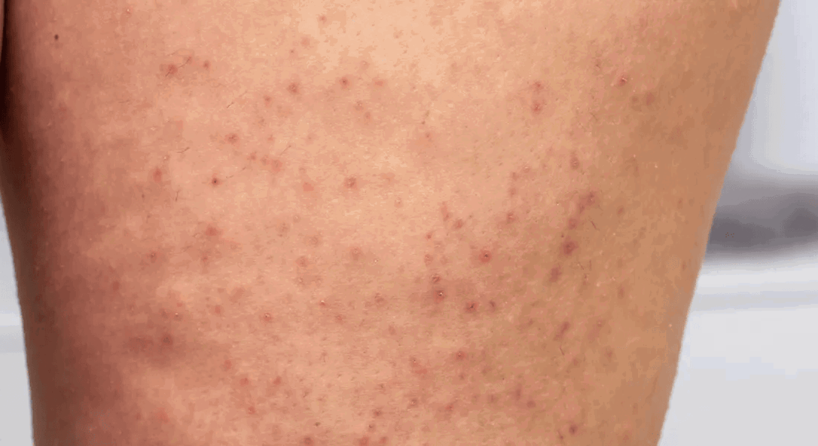 Poils incarnés ? Voici ce que vous pouvez faire