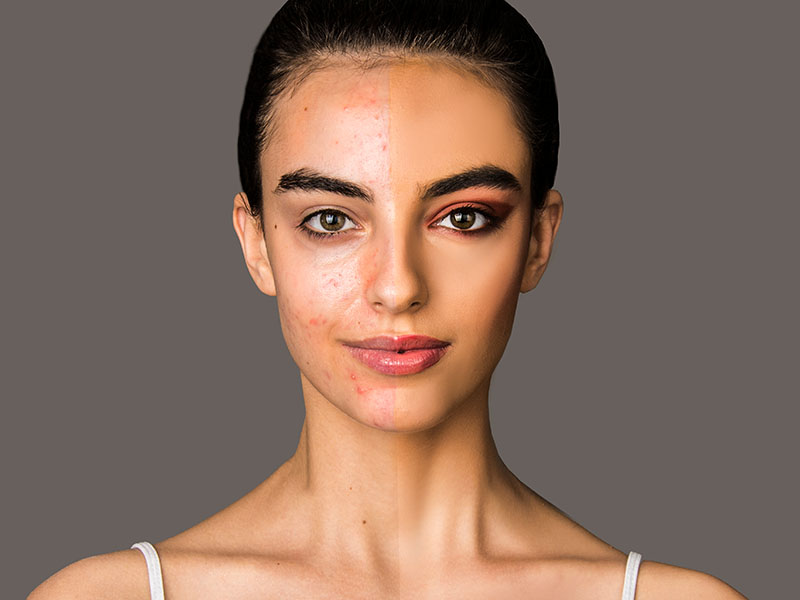 Make-up tips voor acne-gevoelige huid. Informatie