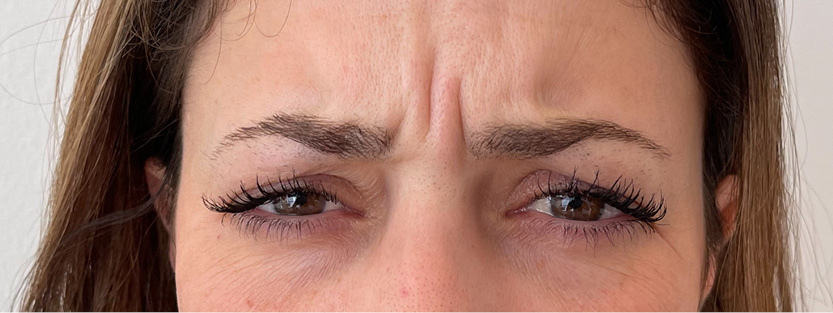 Botox behandeling voor fronsrimpel | Cosmetique Totale