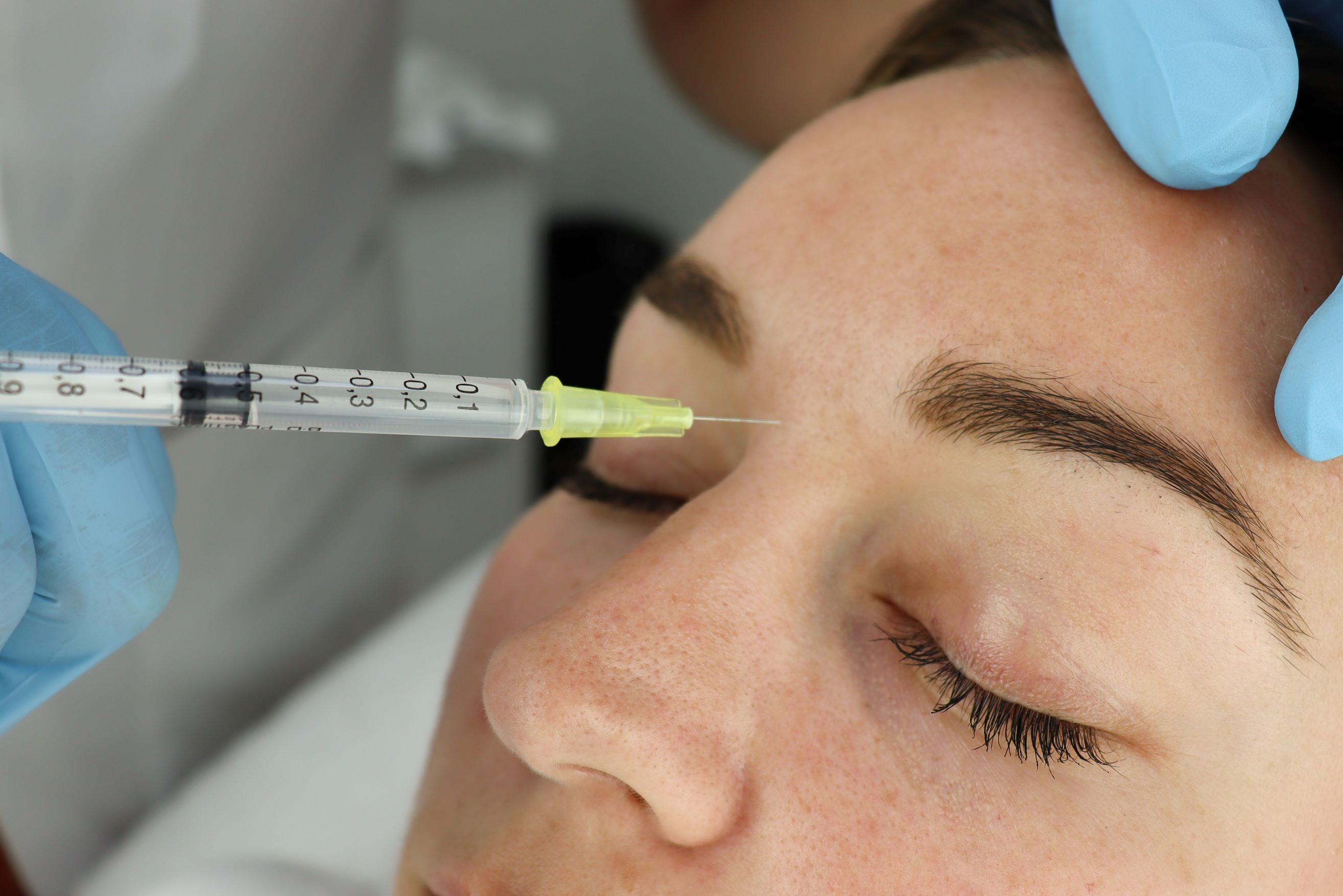 Botox behandeling voor fronsrimpel | Cosmetique Totale