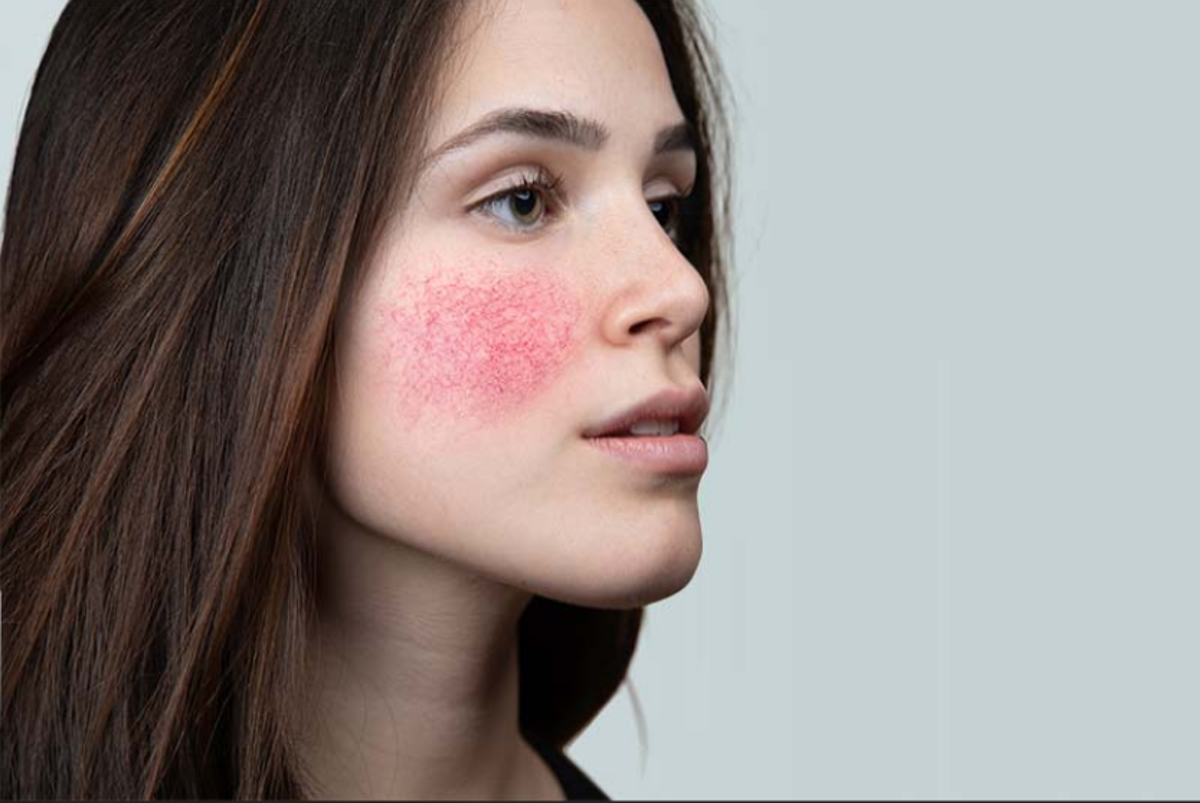 Rougeurs sur votre visage | Rosacée & couperose