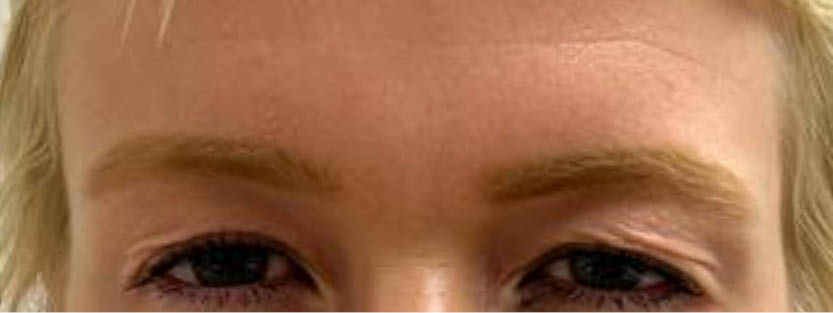 Botox behandeling voor fronsrimpel | Cosmetique Totale