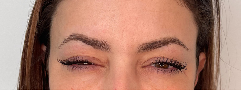 Botox behandeling voor fronsrimpel | Cosmetique Totale