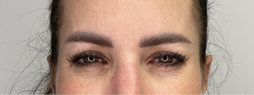 Botox behandeling voor fronsrimpel | Cosmetique Totale