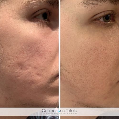 Uitleg over acne littekens en de behandel mogelijkheden