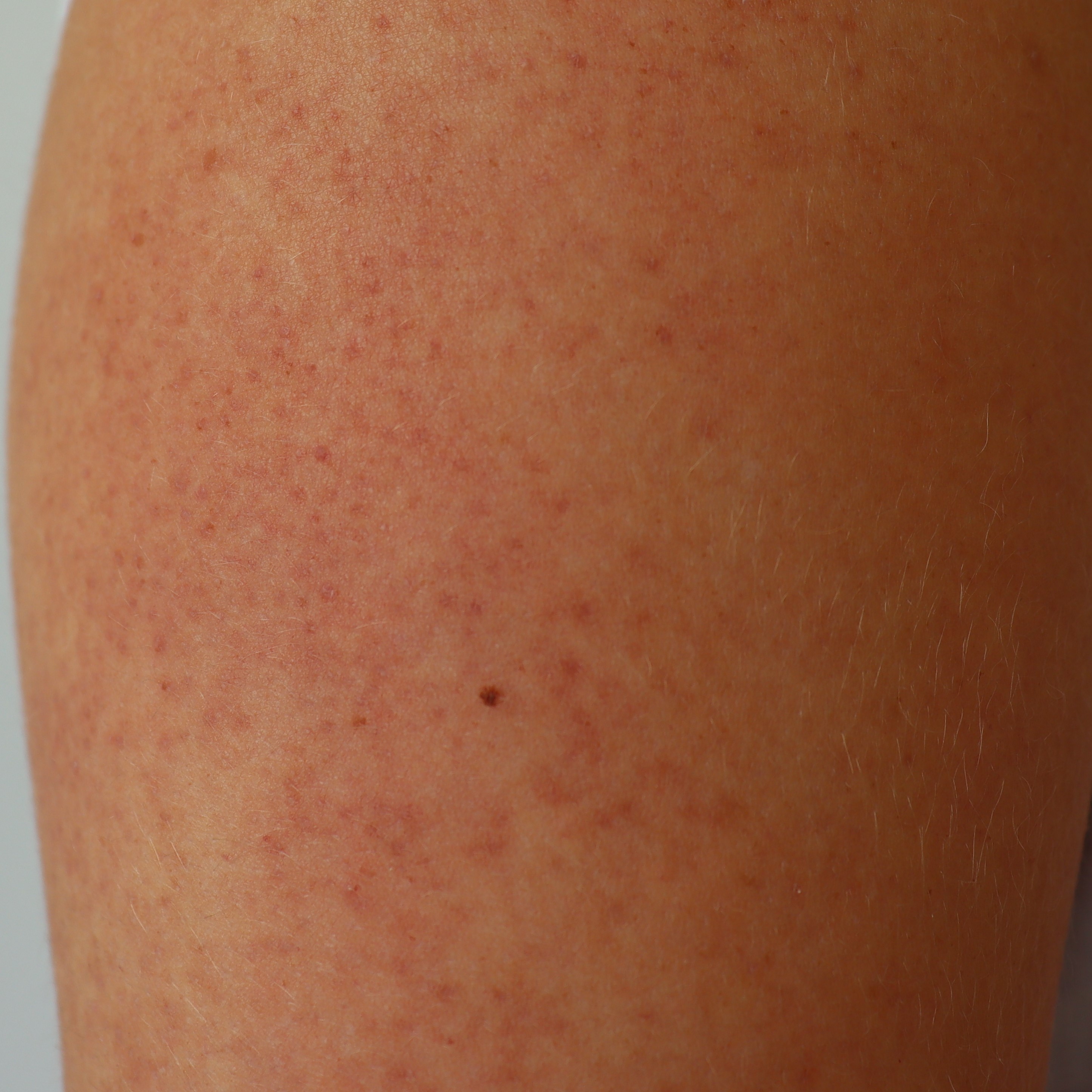 Keratosis pilaris behandeling| Cosmetique Totale